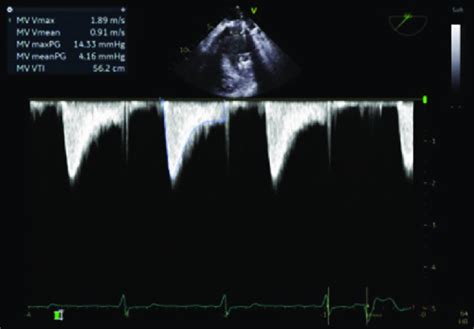 Post Procedure Transesophageal Echocardiogram Continuous Wave Inflow