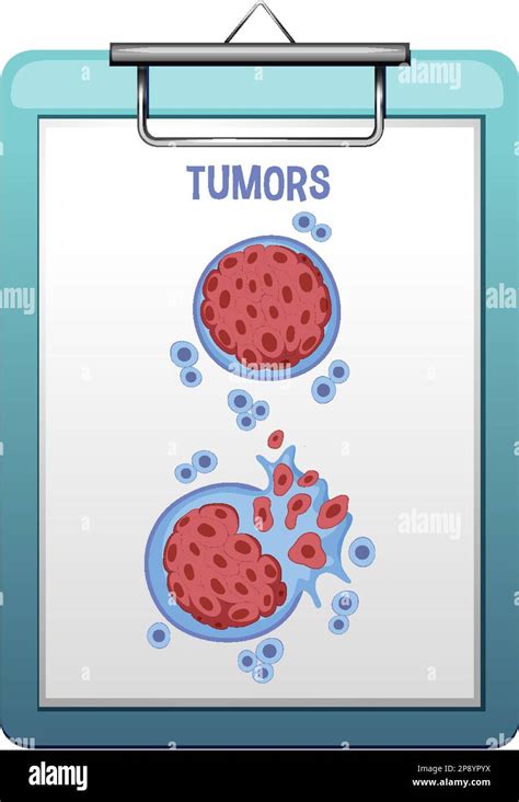 Tumor Cell And Cancer Development Illustration Stock Vector Image And Art