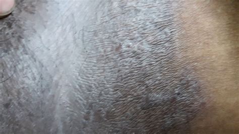 Tinea Cruris YouTube