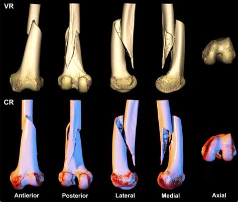 Classification Of Distal Femur Fractures And Their
