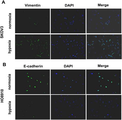 Hypoxia Induced Epithelial To Mesenchymal Transition Emt Phenotype In
