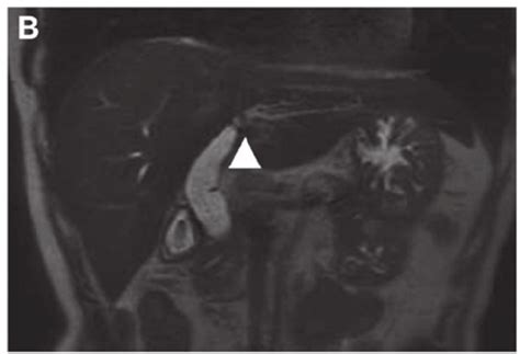 Endoscopic Retrograde Cholangiopancreatography Demonstrated A Severe Download Scientific