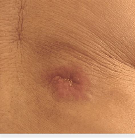 Figure 1 From Primary Cutaneous Adenoid Cystic Carcinoma Of The Back A