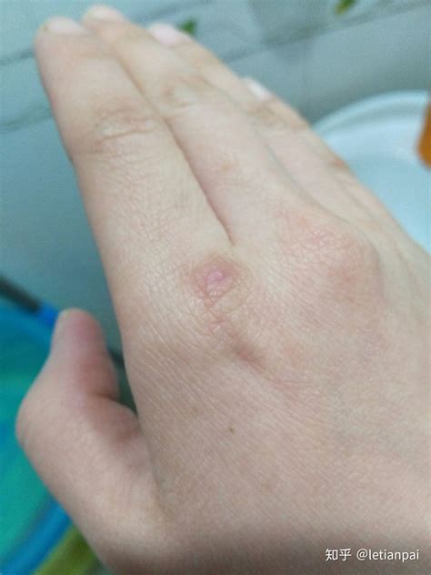 为什么同样是摔伤跌倒磕碰擦伤，其他人都是很快伤口结痂愈合，我怎么一个月还没痊愈。？ 知乎