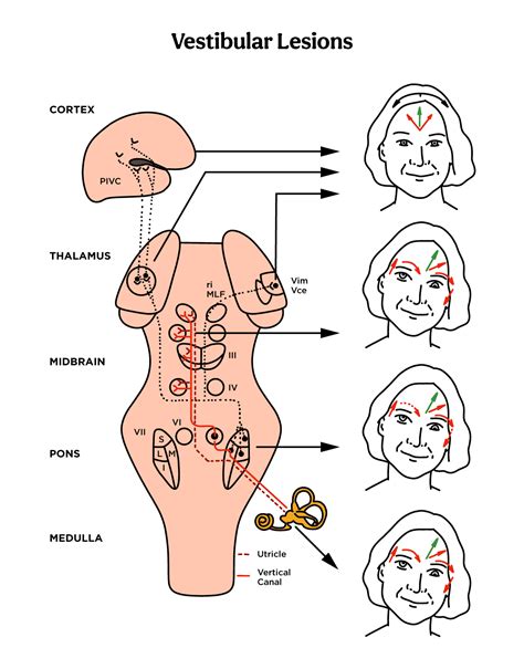 Testing And Management Of Skew Deviation