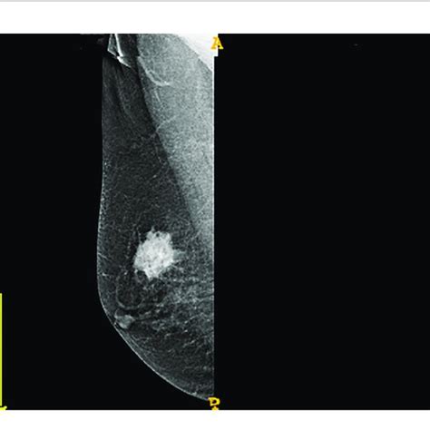 The Diagram Of The Breast Tumor Segmented Download Scientific Diagram