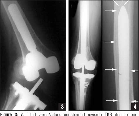 Figure 3 From The Role Of Implant Constraint In Revision Total Knee