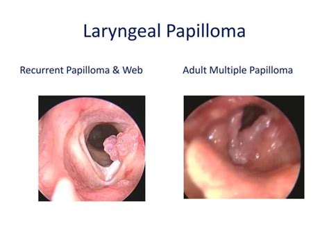 Stroboscopy Larynx Ppt Free Download