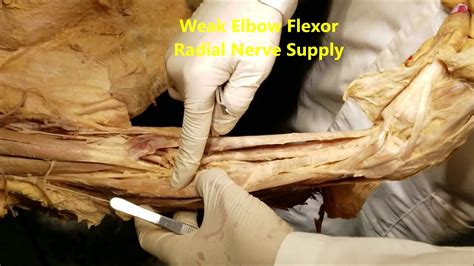 Wrist Extensor Compartments And Radial Nerve With Clinical Aspects