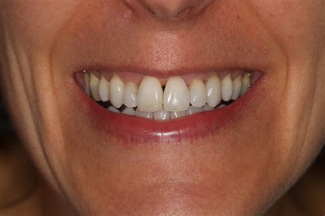 Dental Bonding Black Triangles At Craig Alston Blog