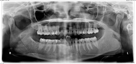 Toronto Invisalign Brand New Smile Interproximal Reduction IPR For Invisalign In Toronto