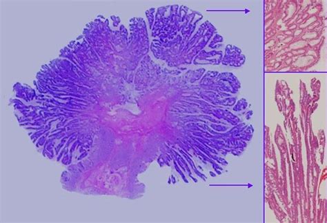 Tubulovillous Adenoma