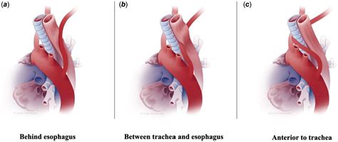 Aberrant Right Subclavian Artery Intervention Can Provide Relief Of