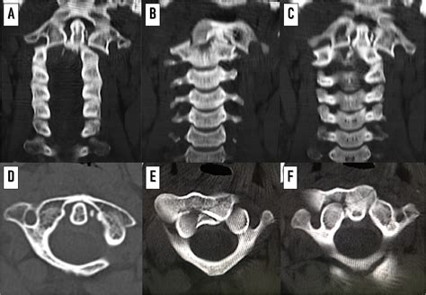 Atlantoaxial Joint Subluxation