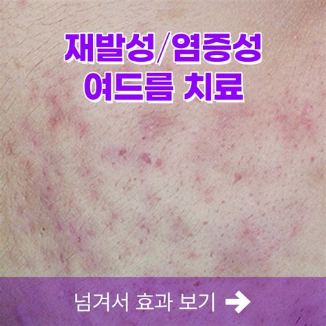 2세대 골드ptt를 이용한 여드름 치료는 재발성 염증성 좁쌀여드름 등 여드름 개선에 매우 효과적입니다 여드름치료 잘하는 피부과를 찾고있다면 클린업피부과를 꼭 기억해