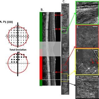 A The 10 2 VF Total Deviation Plots For Patient 2 B The Vertical Download Scientific