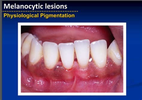 Pigmented Lesions Schneider Flashcards Quizlet
