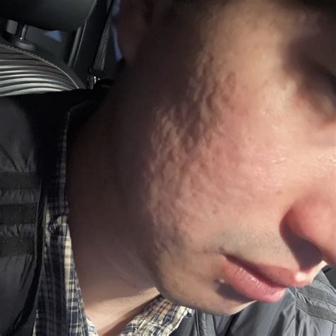 여드름 흉터 치료 서브시전 가격 문의 에스앤유 김방순 피부과