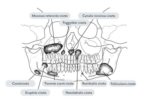 Foggyökér Ciszta állcsont Ciszta