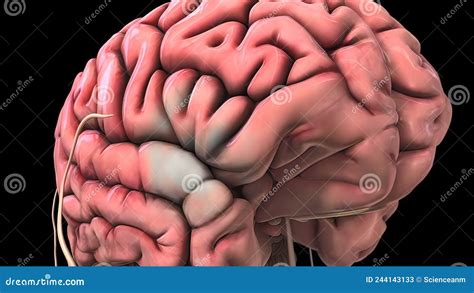 Lesão Cerebral Causa Hemorragia Cerebral Ilustração Stock Ilustração