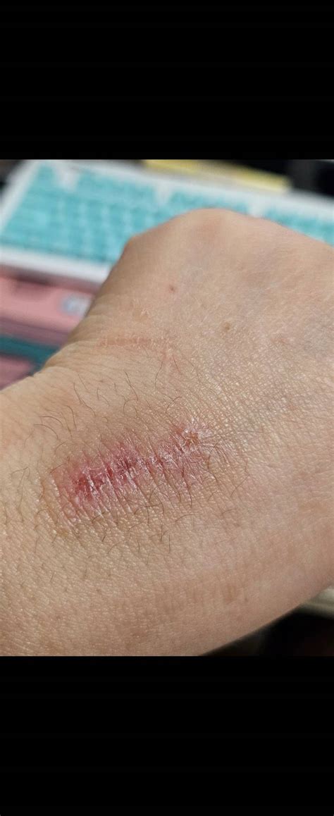 [잡담] 상처 주위에 털 자란 거 봐ㅋㅋㅋ 인스티즈 Instiz 일상 카테고리