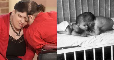 Worlds Oldest Conjoined Twins Lori And Georges Schappell Die At 62