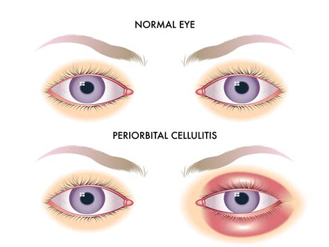 Anatomy Orbital Cellulitis