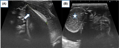 A B Postnatal Ultrasound Of The Newborn Shows Show Heterogeneously Download Scientific
