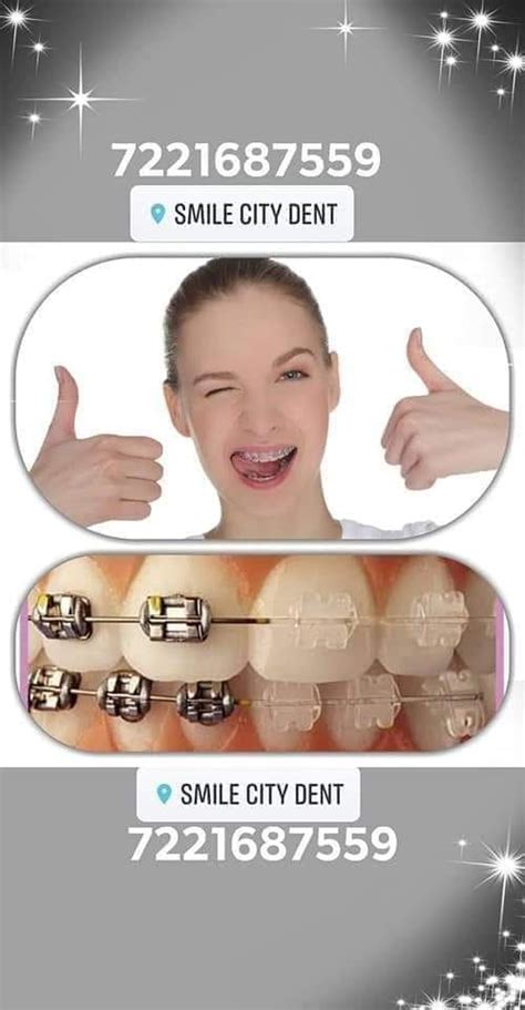 Smile City Dent Ortodoncia Con Brackets Metálicos Con