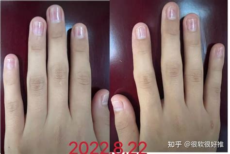 灰指甲治疗记录（更新中） 知乎