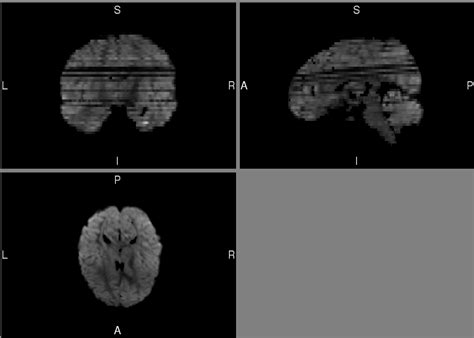 Dti Quality Control Part Acquisition Diffusion Imaging Introduction Tutorials And