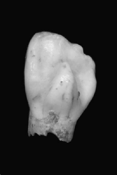 Left Deciduous Maxillary Lateral Incisor Distal View The Arrow Points Download Scientific