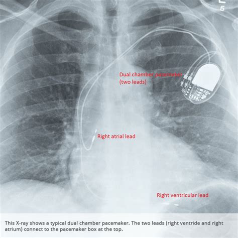 Dual Chamber Pacemaker Xray