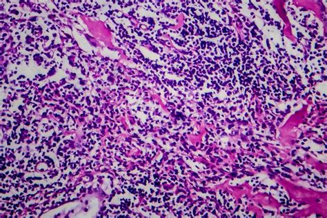 Endometrial Adenocarcinoma Light Micrograph Photo Microscope Stock