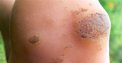 Un remède naturel surprenant mais efficace afin de soigner une verrue