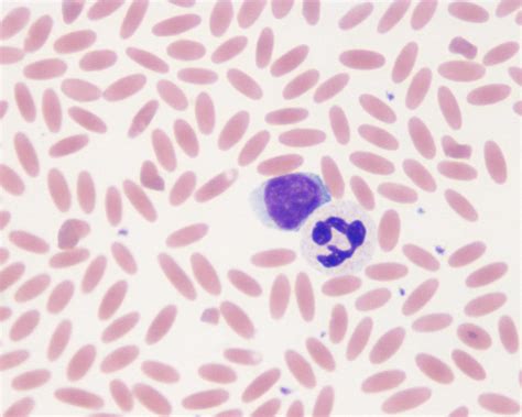 Reactive Lymphocyte Archives Eclinpath