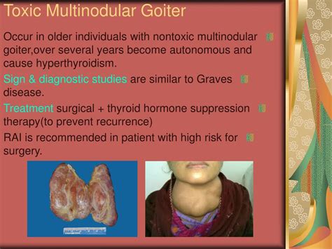 Ppt In The Name Of God Thyroid Benign Disease Nazila Abrishami June