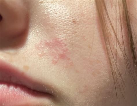 Dry Skin Patches On Face Winter Skincare Natural Remedies For Dry