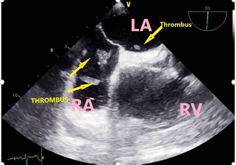 Clot In Transit With Pulmonary Embolism Treat In Time Shm Abstracts
