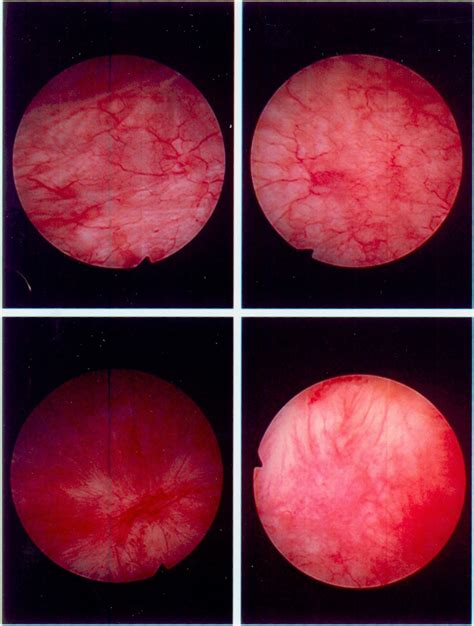 Radiation Cystitis Review Article