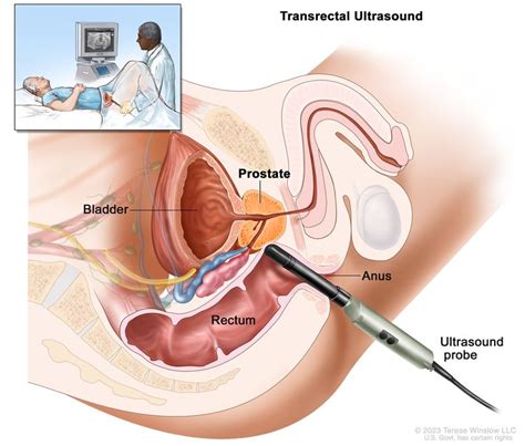 Prostate Cancer Treatment Ny Montefiore Einstein Comprehensive