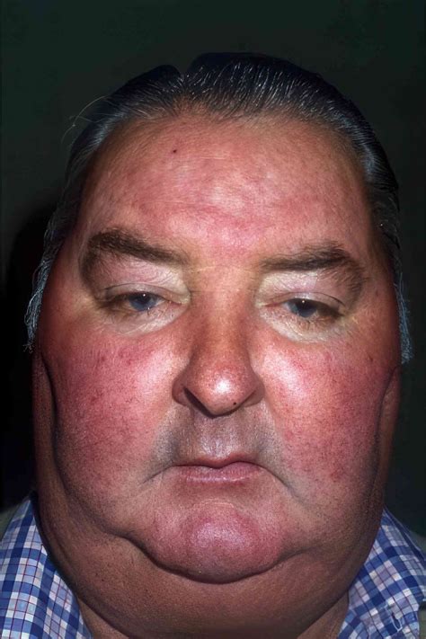 What Does A Moon Shaped Face Look Like Infoupdate Org