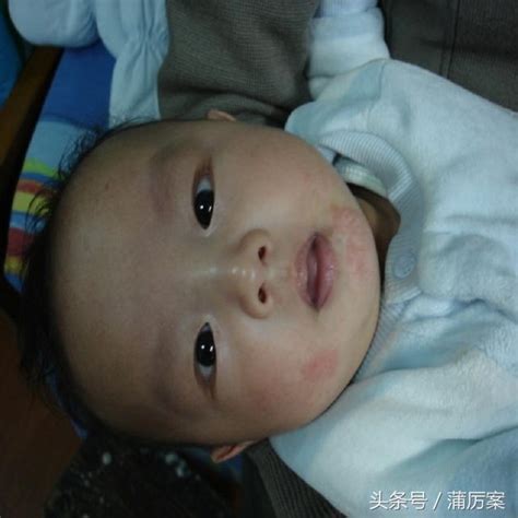 嬰兒濕疹 照這樣做好得快，為了寶寶的健康來款這吧 每日頭條