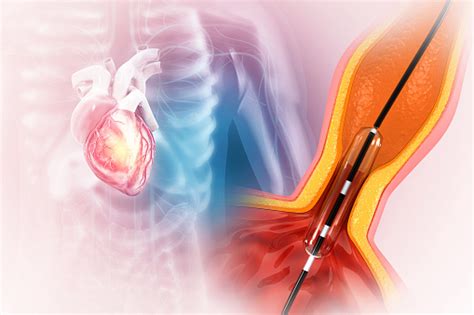 정맥에 스텐트와 풍선 혈관 성형술 절차 3d 일러스트레이션 Stenosis에 대한 스톡 사진 및 기타 이미지 Stenosis