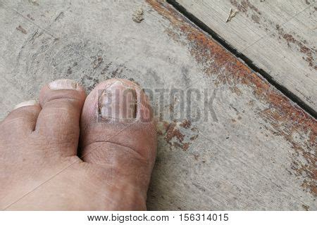 Ingrown Nail Big Toe Image Photo Free Trial Bigstock