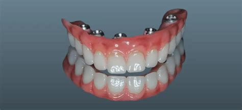 Prótese Sobre Implante O Que é Vantagens E Como Funciona