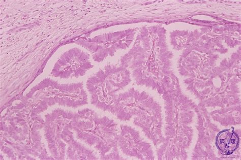 14breast 4 Intraductal Papillomapathology Core Pictures