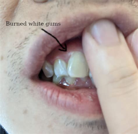 Treating Burned Gums From Teeth Whitening 1311 Jackson Ave Dental