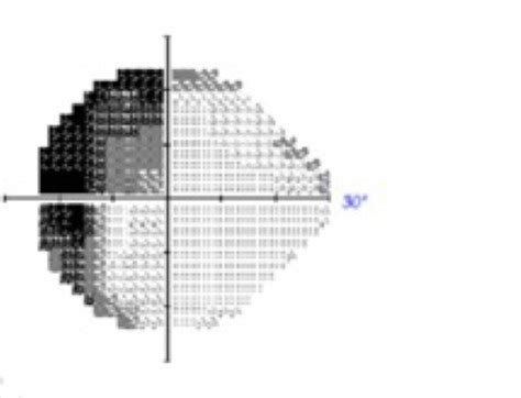 Glaucoma Automated Visual Fields Part Flashcards Quizlet