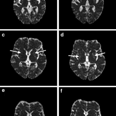 A ‘‘hot Cross Bun Sign Seen On An Axial T2 Weighted Mri In A Patient